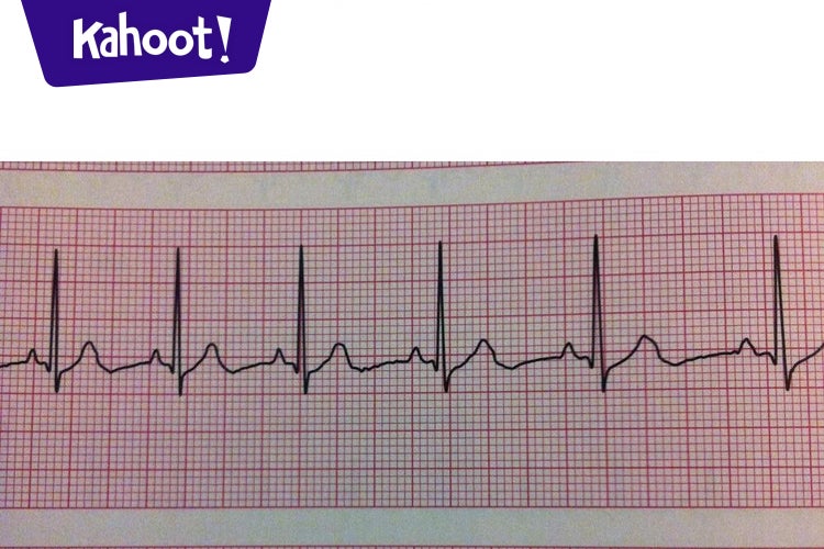 NP I Unit 5 Cardiac Nursing Assessment - Kahoot! Quiz