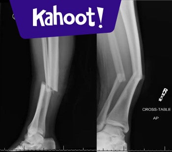Appendicular Skeleton Part II: Pelvis and Legs - Kahoot! Quiz