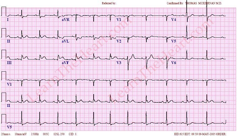 12 Leads Practice - Kahoot! Quiz
