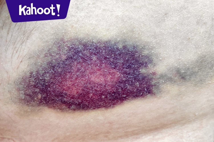 EMT Chapter 27 Soft Tissue Injuries - Kahoot! Quiz